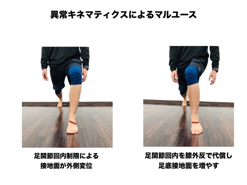 Knee-in Toe-outに対する理学療法 | 理学療法士×アスレティックトレーナーのブログ