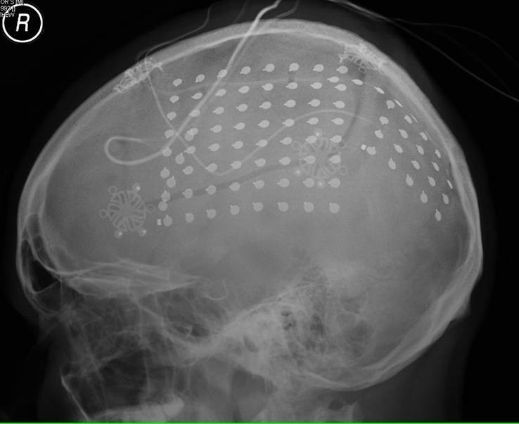 ブレインテックABC〜脳を読み取り・脳に書き込む基礎技術｜Ray | Ai Brain Catalyst｜note