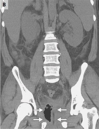 Emphysematous Prostatitis｜佐藤 嵐士｜note
